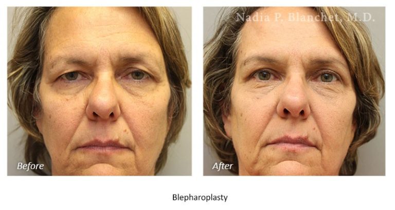 Blepharoplasty (Eyelid Tuck) Gallery - Nadia P. Blanchet, M.D.