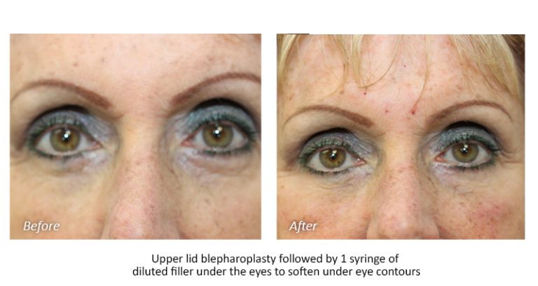 ER-Bleph-Before-and-After - Nadia P. Blanchet, M.D.