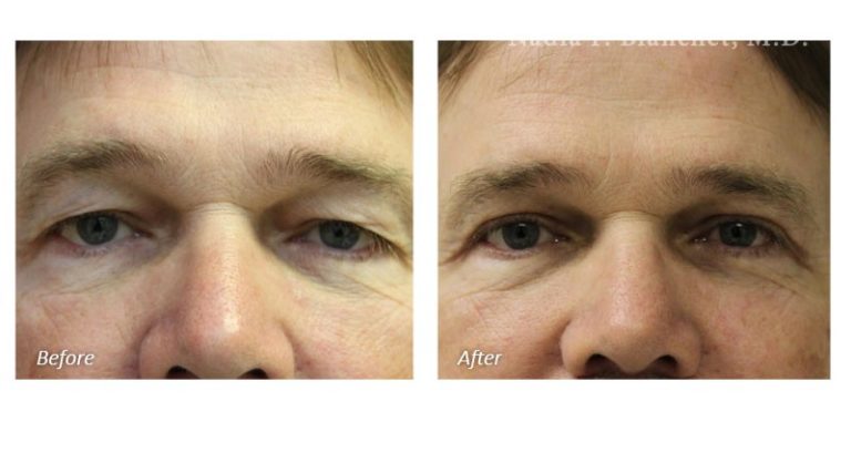 Blepharoplasty (Eyelid Tuck) Gallery - Nadia P. Blanchet, M.D.